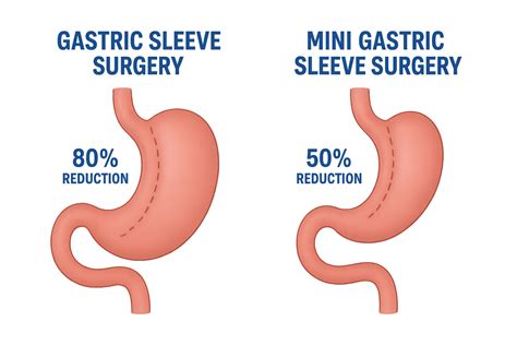 Gastric Bypass Reversal Cost Recovery And Outcomes