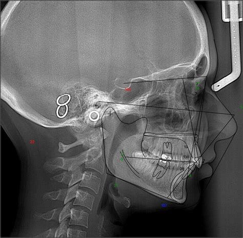 Class Ii Division 2 Malocclusion Patient Measured With T Scan Digital