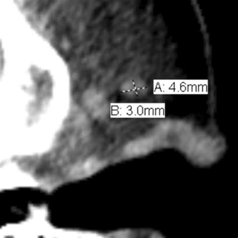 Intraparotid Lymph Node Size Decreases With Age Download Scientific Diagram