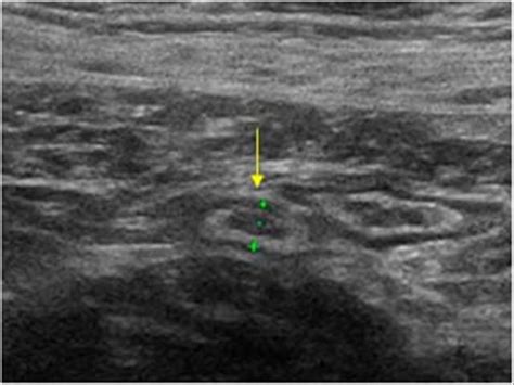 Abdomen And Retroperitoneum 1 5 Appendix Case 1 5 1 Normal Appendix
