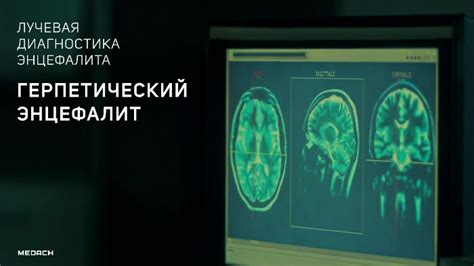 Лучевая диагностика энцефалитов: герпетический энцефалит