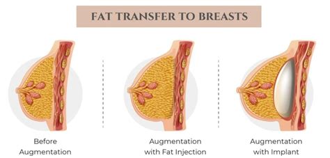 How Fat Transfer Enhances Natural Breast Augmentation Safety