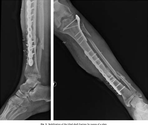 Figure 3 From Reconstruction Of A Tibial Diaphyseal Bone Defect Using