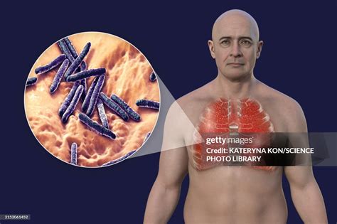 Miliary Lung Tuberculosis Illustration High Res Vector Graphic Getty