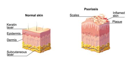 Natural And Alternative Treatments For Scalp Psoriasis RemedyGrove