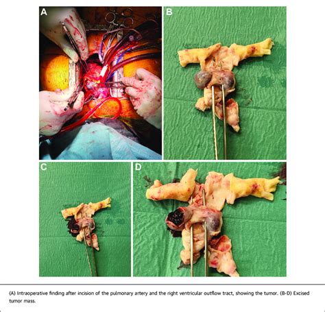 Macroscopic Tumor Findings Download Scientific Diagram