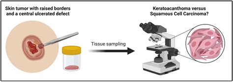 Keratoacanthoma Versus Squamous Cell Carcinoma Histopathological