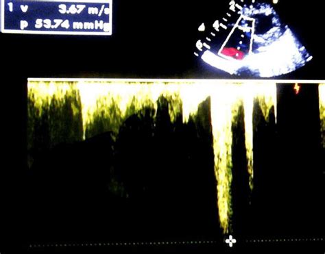 Doppler Echocardiography Showing Ventricular Outflow Gradient