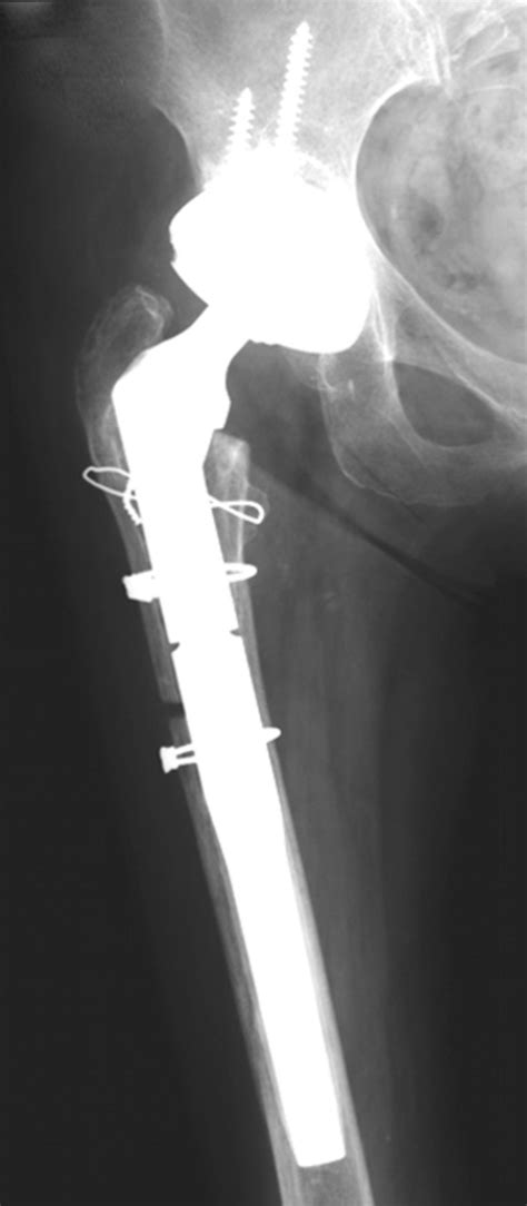 Revision Total Hip Arthroplasty In Patients With Extensive Proximal Femoral Bone Loss Using A