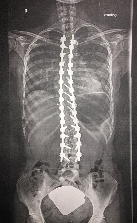 Muscle Recovery Acdf R Spinalfusion