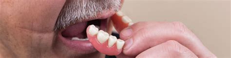 Dentures False Teeth Dr Smithas
