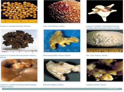 Diseases Of Excretory System Ppt