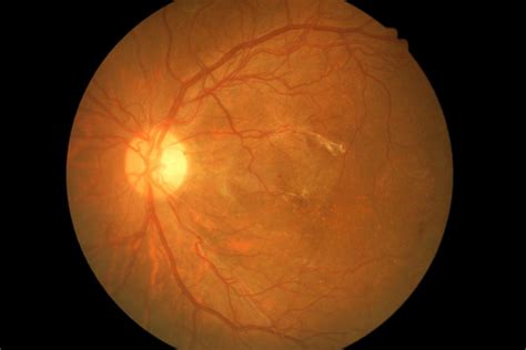Neovascularization The Growth Of New Blood Vessels In The Retina