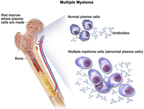 Myeloma Multiple Myeloma Causes Symptoms Stages Prognosis