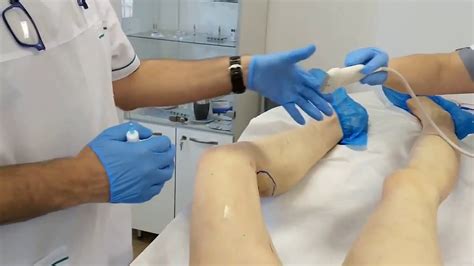 Д р Галили склерозиране на вени Youtube