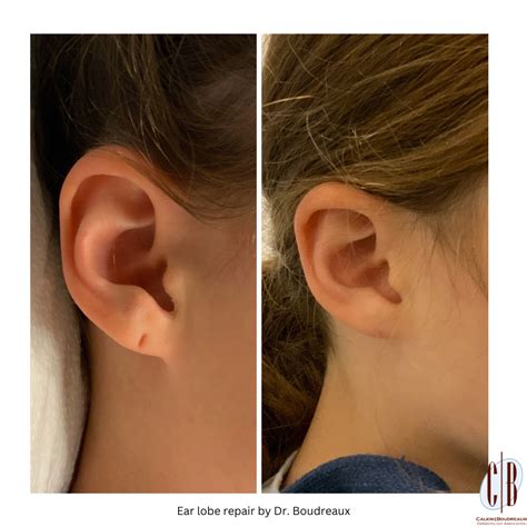 Repairing Stretched Earring Holes