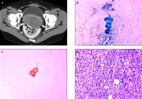 A Contrast Enhanced Ct Scan Shows A Large Heterogeneous Moderately