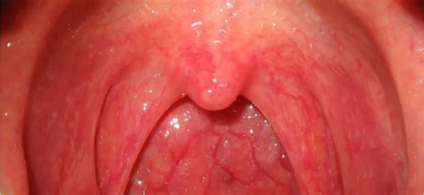 Pharyngitis Symptoms Causes Diagnosis Treatment Explained