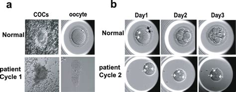 Morphology Of Patients Oocytes A Cumulus Oocyte Complexes Cocs And Download Scientific