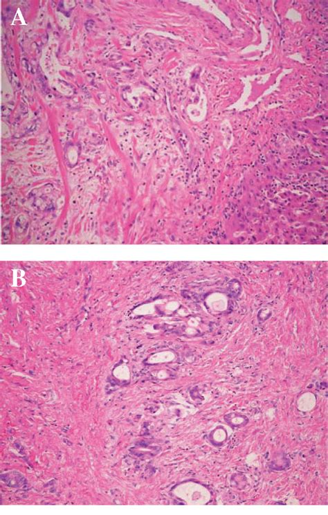 Malignant Neoplasm Of Spermatic Cord Semantic Scholar