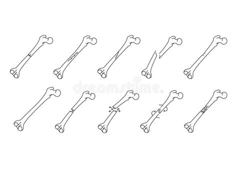 Bone Fracture Line Icons Set Vector Isolated Element Stock Vector Illustration Of Transverse