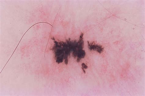 Melanocytic Nevi Recurrent Nevus Perri Dermatology