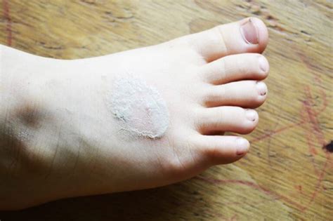 Diy Itch Be Gone Paste