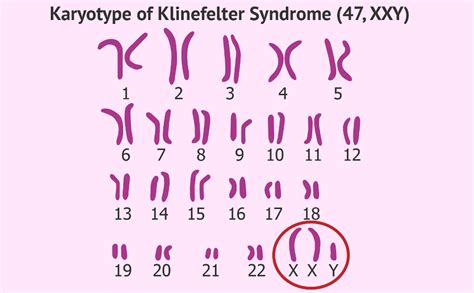 Sex Chromosome Abnormalities