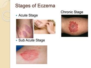 Allergy Pptx