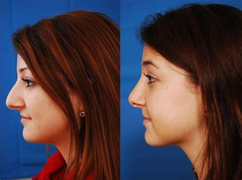 Different Parts Of A Person S Nose They Want Changes Dr Reilly