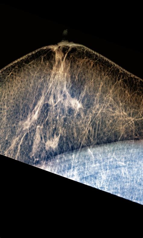 inbreast zzlbj fsod xshk object detection dataset by rf100vltemp