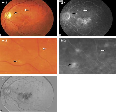 Quantification Of Fluorescein Stained Drusen Associated With Retina