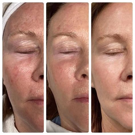 Pico Genesis Revive At The Group Med Spa