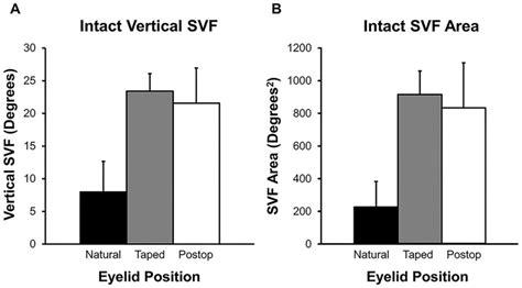Tangent Screen Perimetry In The Evaluation Of Visual Field Defects Associated With Ptosis And