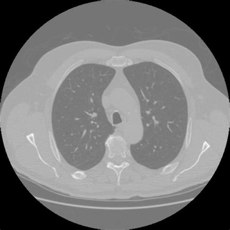 Breast Cancer Detection Breast Cancer Detection Sdfre Roboflow Universe