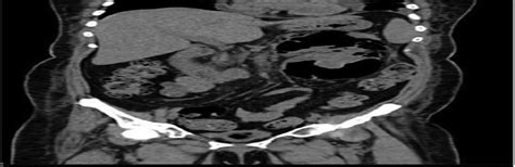 Extensive Emphysematous Pyelonephritis In Association With H Journal Of The Scientific Society