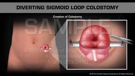 Diverting Sigmoid Loop Colostomy Youtube