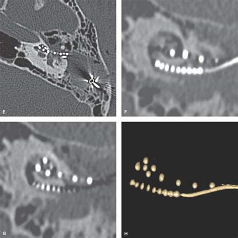 Labyrinthitis Radiology Key