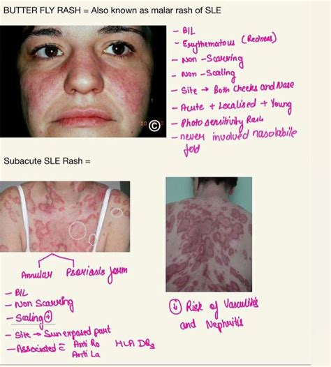 Sle Skin Manifestations Medizzy