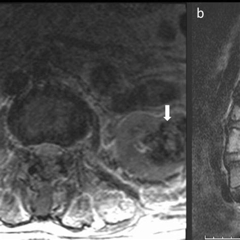 A 68 Year Old Female Patient Showing Dilated Cbd With Distal Cbd Stone Download Scientific