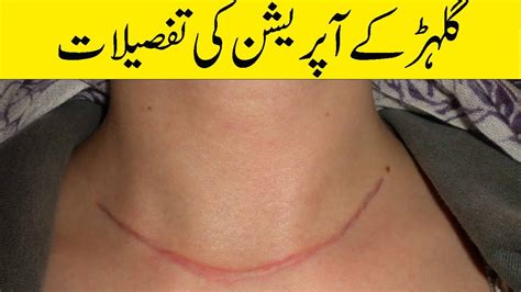 Thyroid Surgery Thyroidectomy گلہڑ کا آپریشن थाइरोइड Youtube