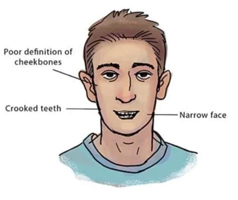 Mewing Appliance A Device To Improve Your Facial Appearance