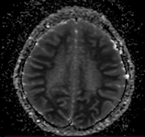 Diffuse Gyriform Restriction In Mri Brain A Feature Of Hypoxic Injury