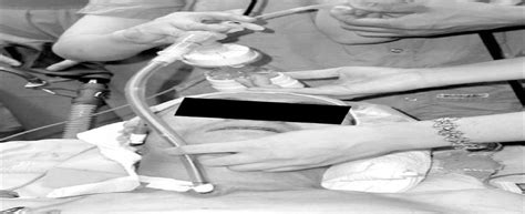 One Lung Ventilation Using A New Bronchial Blocker In A Pati Anesthesia And Analgesia