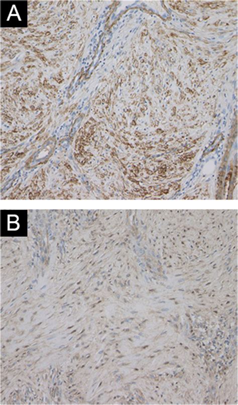 Hypertrophic Scar Mimicking Peristomal Pyoderma Gangrenosum Anais