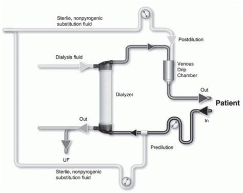 Hemodiafiltration Basicmedical Key