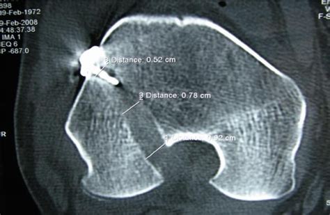 Figure 1 From Comparison Of Tunnel Widening Between Interference Screw And Suture Disc Fixation