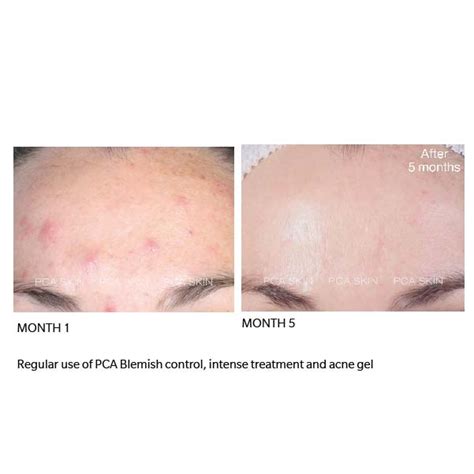 Pca Skin Acne Gel Acne Treatment With 2 Salicylic Acid Uk