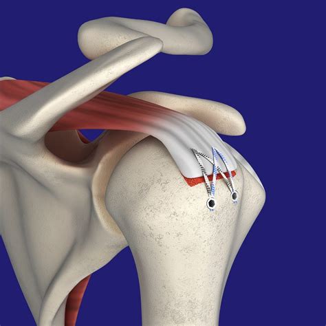 Rotator Cuff Repair Osteocare