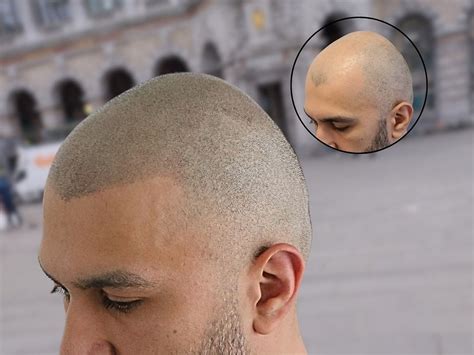 Discover The Transformative Power Of Scalp Micro Pigmentation Your